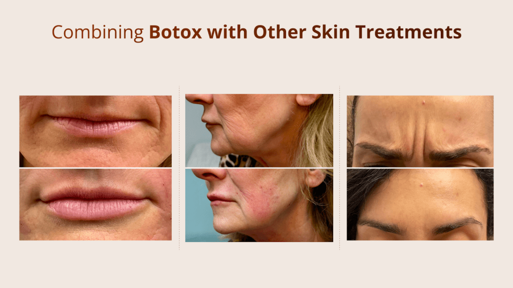 Combining 'tox with Other Skin Treatments for Maximum Effect ...