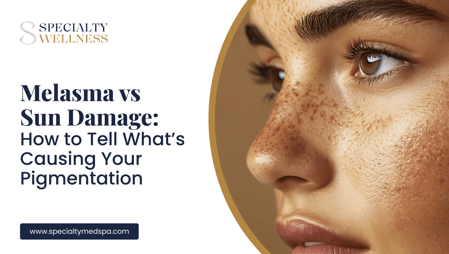 How to Get Rid of Sun Spots: Top 5 Professional Treatments That Work ...