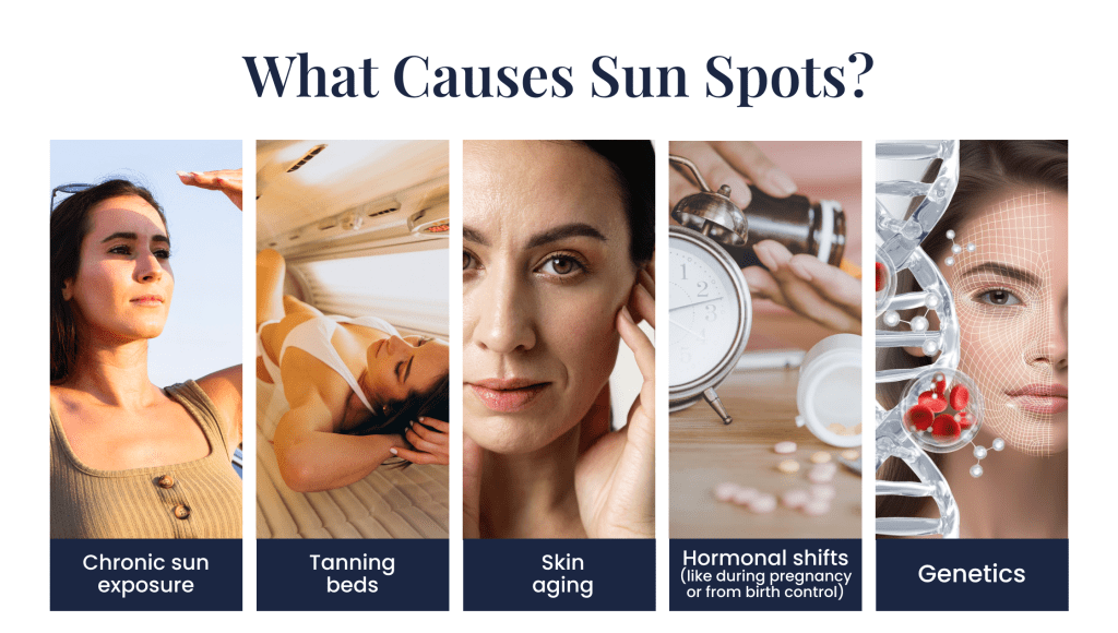 How to Get Rid of Sun Spots: Top 5 Professional Treatments That Work ...
